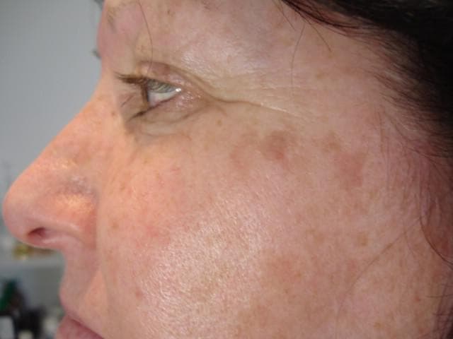 Herbal Peel Australia